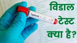 Widal Test Kya Hota Hai? Kab or Kaise Karna Chahiye | MP, CBC